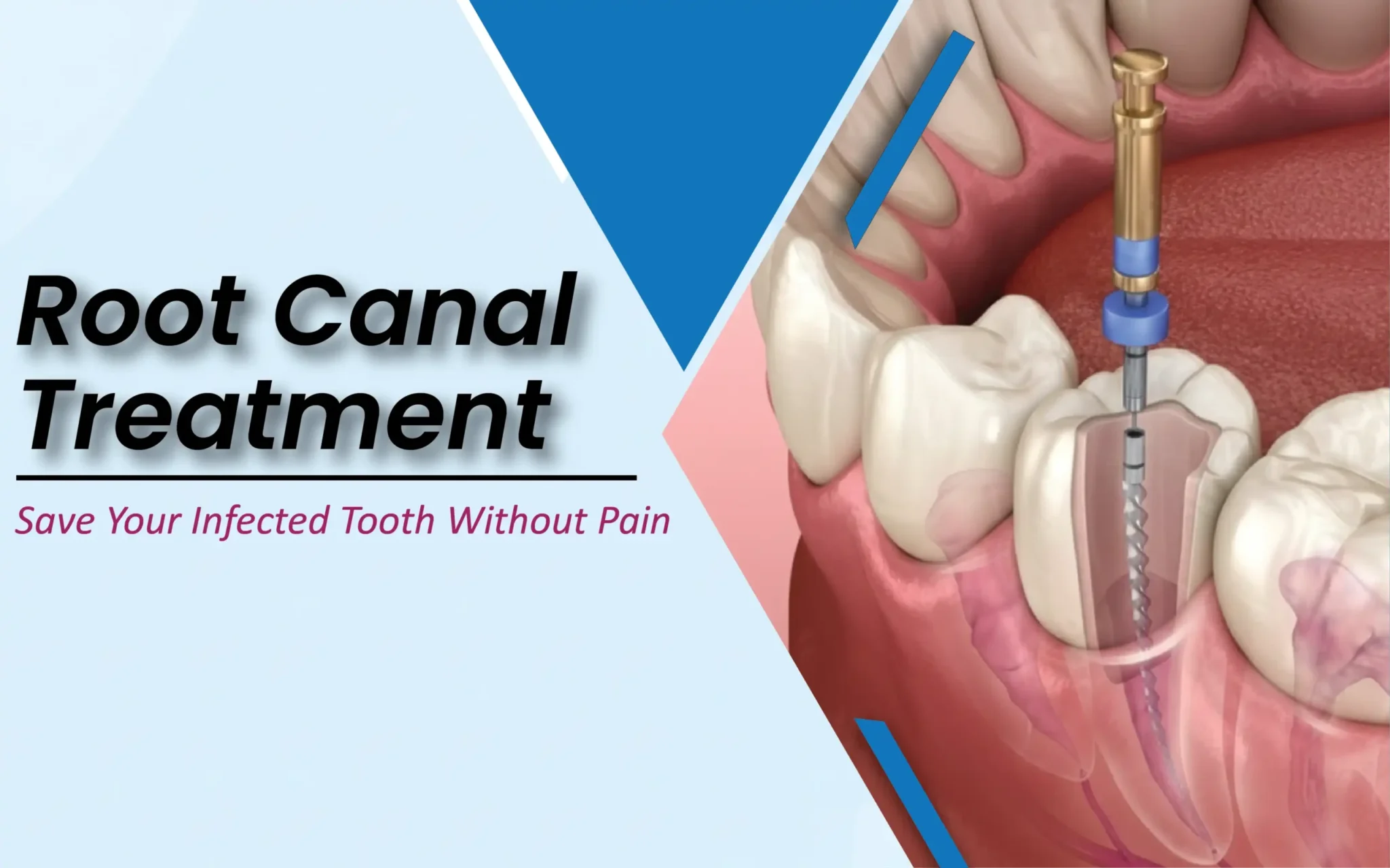 Is Root Canal Painful? Advanced Care in India | MediKaya Healthcare